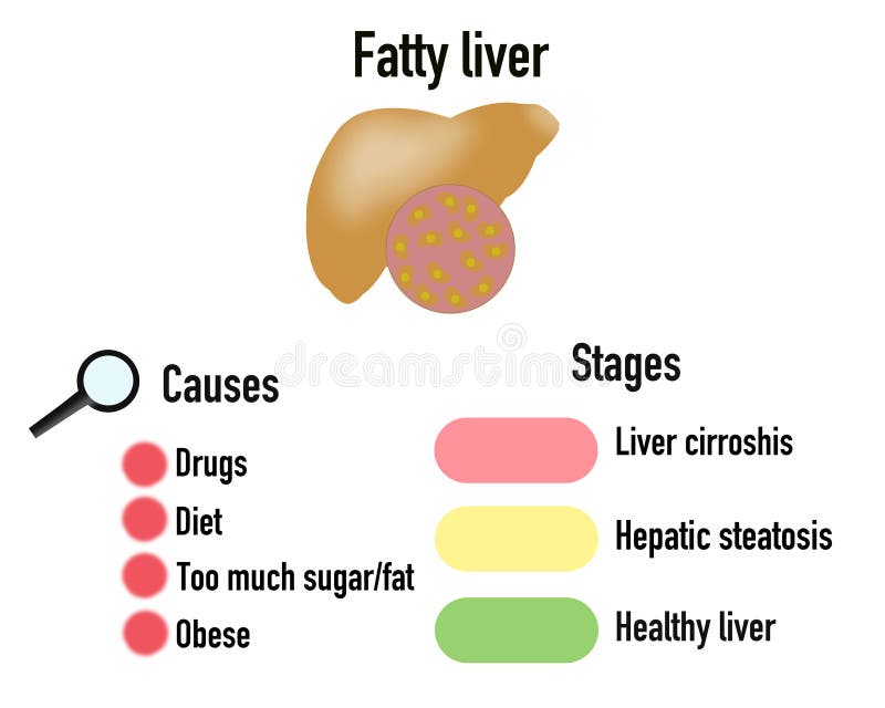 Normal Liver and Fatty Liver, Educational Sheet Stock Photo - Image of ...