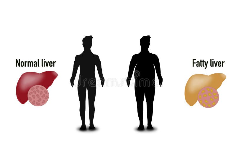 Normal Liver and Fatty Liver, Educational Sheet Stock Image - Image of ...