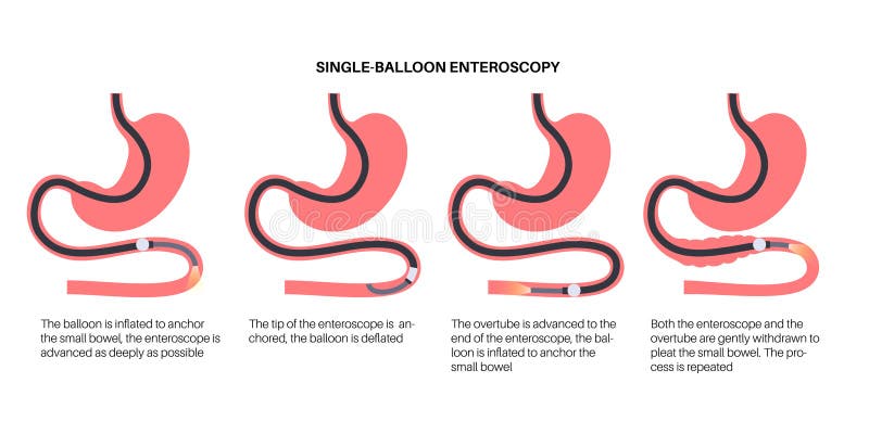Endoscopy Technique Stock Illustrations – 18 Endoscopy Technique Stock ...