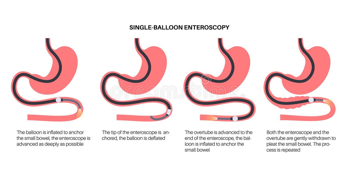 Endoscopy Technique Stock Illustrations – 18 Endoscopy Technique Stock ...
