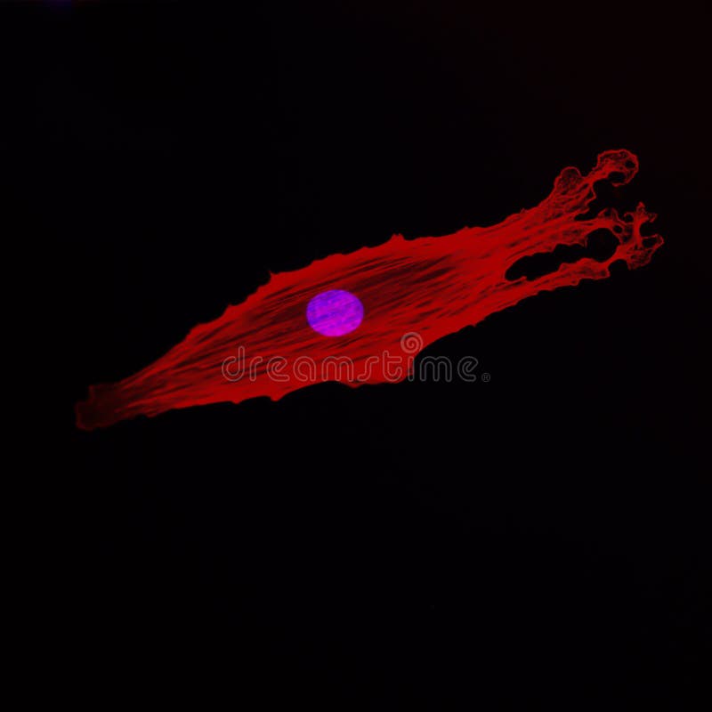 Single Cancer Cell Invading during the Metastatic Process. Visible ...