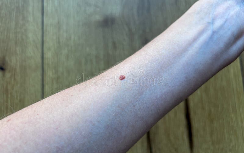 Single Hair in Mole on Arm stock photo. Image of female - 341881054