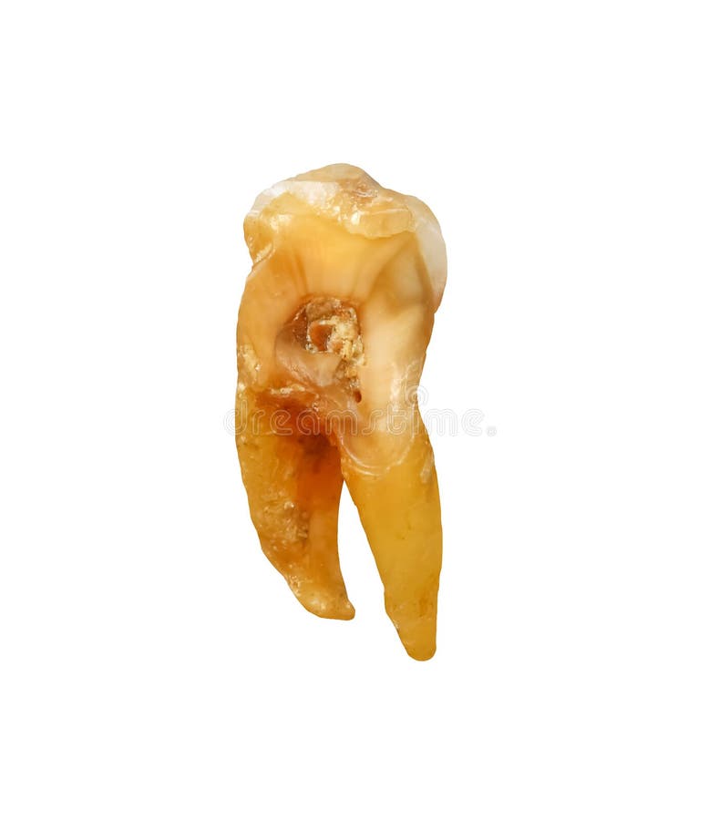 Single Human Tooth with Caries Isolated on White Background , Clipping ...