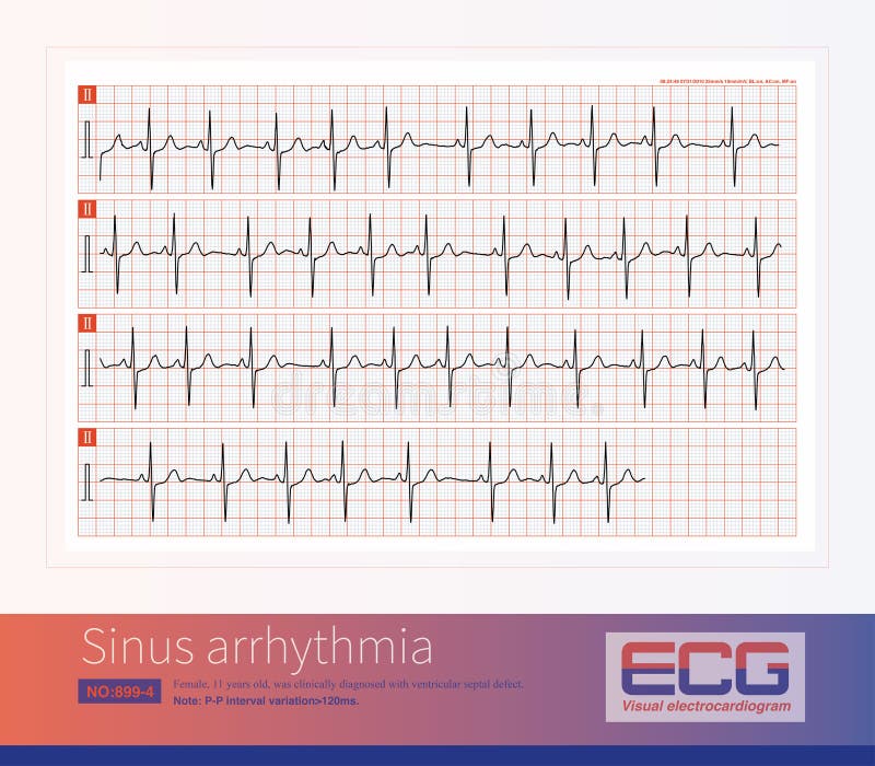Sinus arrhythmia stock photo. Image of education, cardiovascular ...