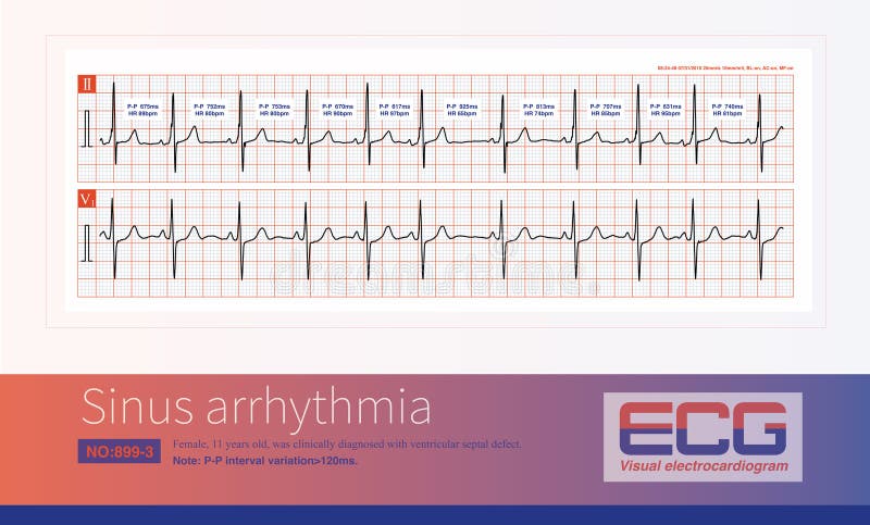 Irregular Impulses Stock Illustrations – 11 Irregular Impulses Stock ...