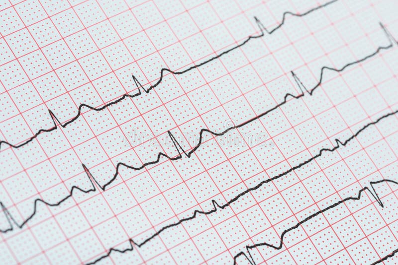 Sinus Heart Rhythm on Electrocardiogram Record Paper Showing Normal ... Sinus Heart Rhythm on Electrocardiogram Record Paper Showing Normal ...