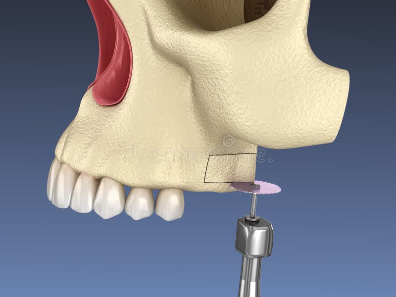Sinus Lift Surgery - Creating Side Access To the Sinus. 3D Illustration ...