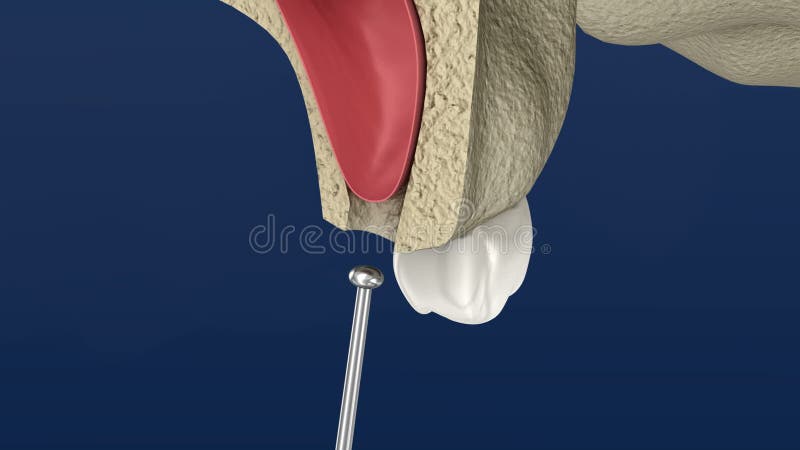 Sinus Lift Surgery - Sinus Augmentation. Stock Video - Video of ...