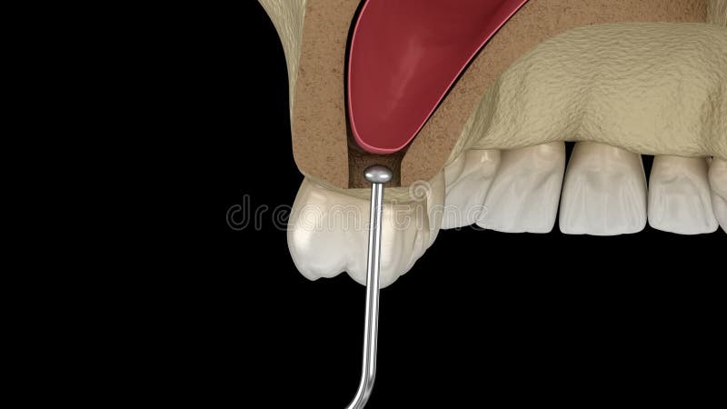 Sinus Lift Surgery - Sinus Augmentation Stock Video - Video of gingiva ...