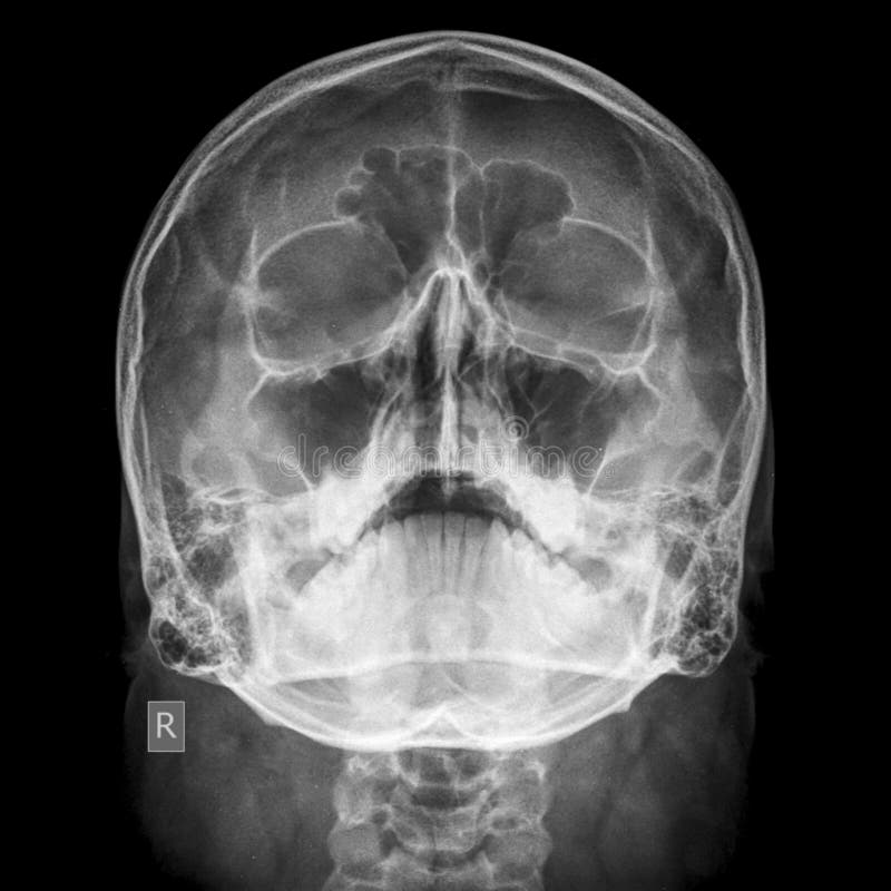 Sinus x-ray image PA view stock photo. Image of radiograph - 296483332
