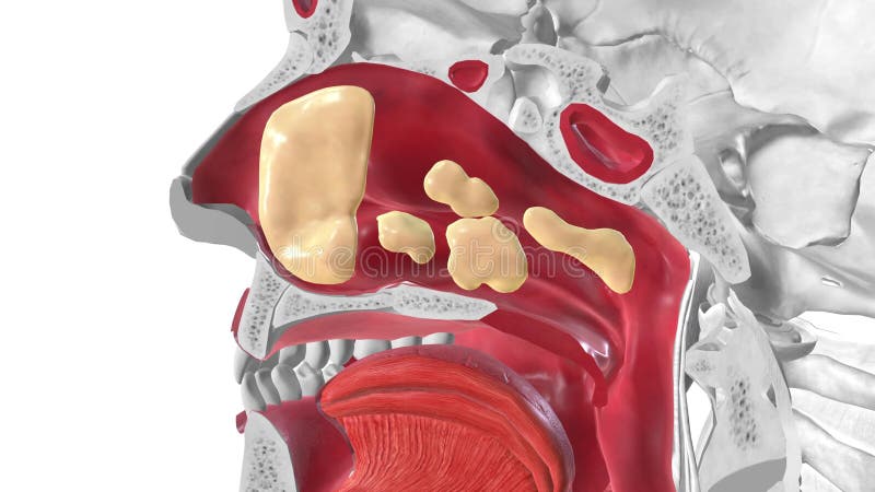 Sinusitis is an Inflammation, or Swelling, of the Tissue Lining Your ...