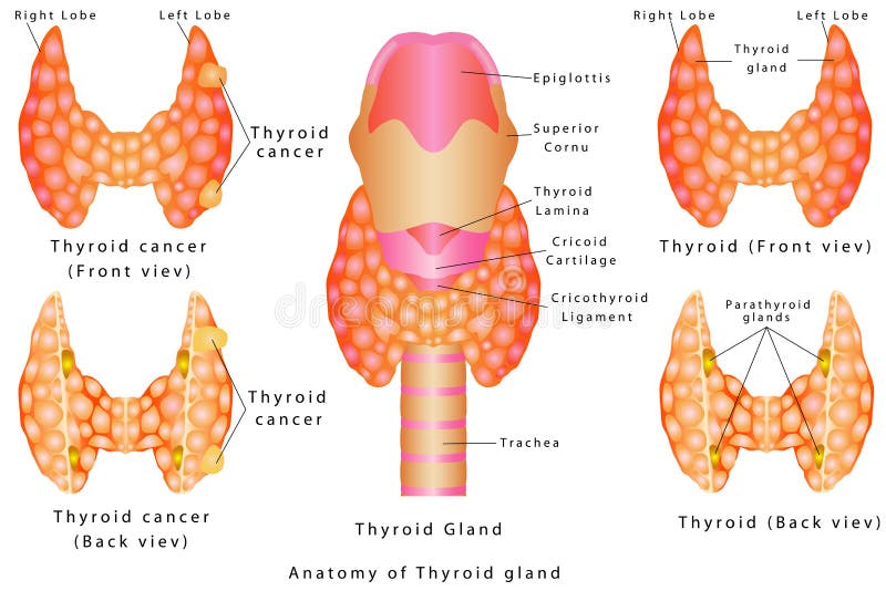 Typer Av Cystor I Det Atypiska Bröstet, Fintrådig Fettig Cysta, Fast ...