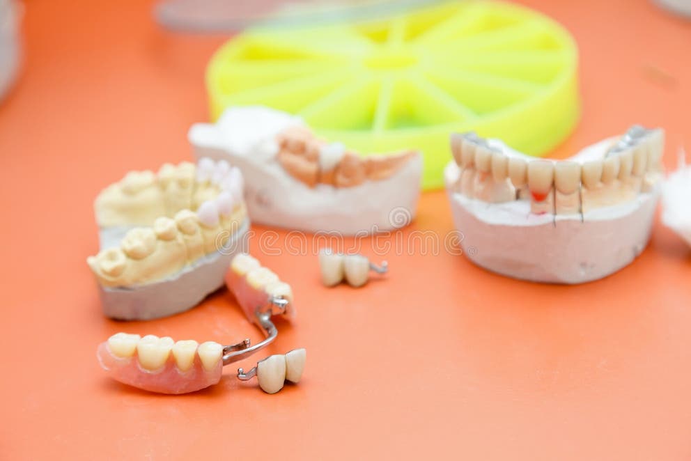 Skeletal Denture Stock Photos - Free & Royalty-Free Stock Photos from ...
