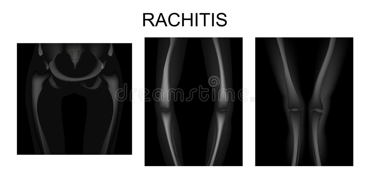 Rickets Pelvis Stock Illustrations – 14 Rickets Pelvis Stock ...