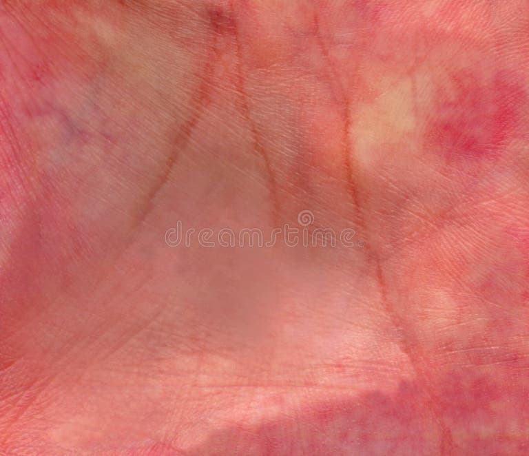 Fragile Skin Stock Illustrations – 326 Fragile Skin Stock Illustrations ...