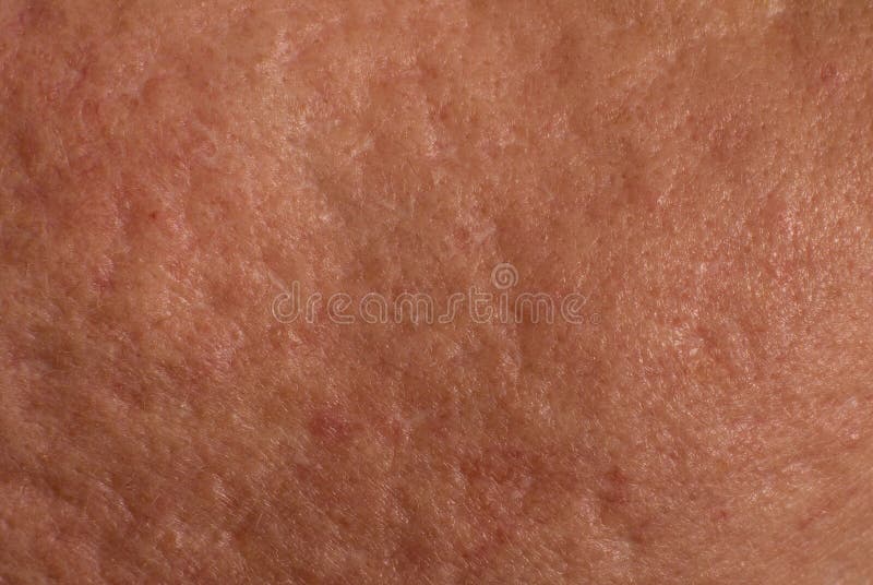 Acne scars on cheek stock photo. Image of pimple, pores - 47291702