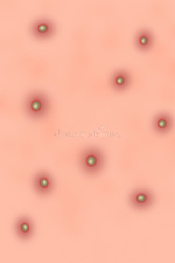 Monkeypox Symptom Stock Illustrations – 564 Monkeypox Symptom Stock ...