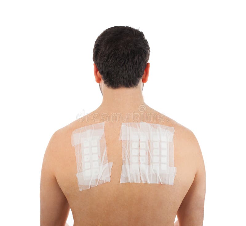 Skin Allergy Patch Test on Bacck Stock Image - Image of health ...