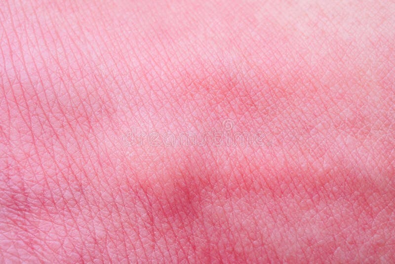 Skin Allergy with Rash after Mosquito Bite Stock Image - Image of itch ...