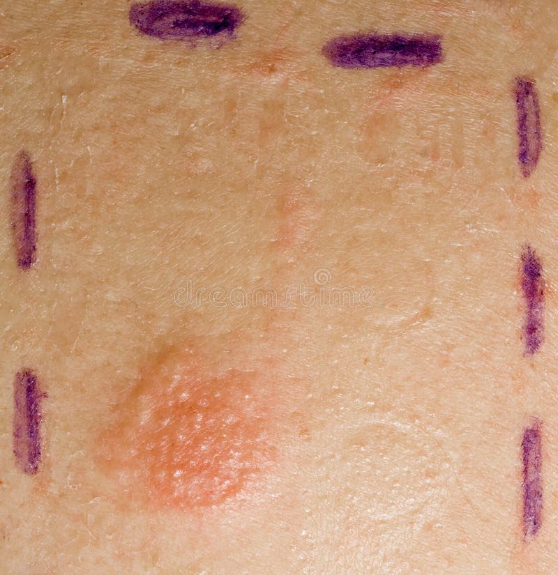Skin Allergy Test stock image. Image of inflamed, epidermis - 12922263
