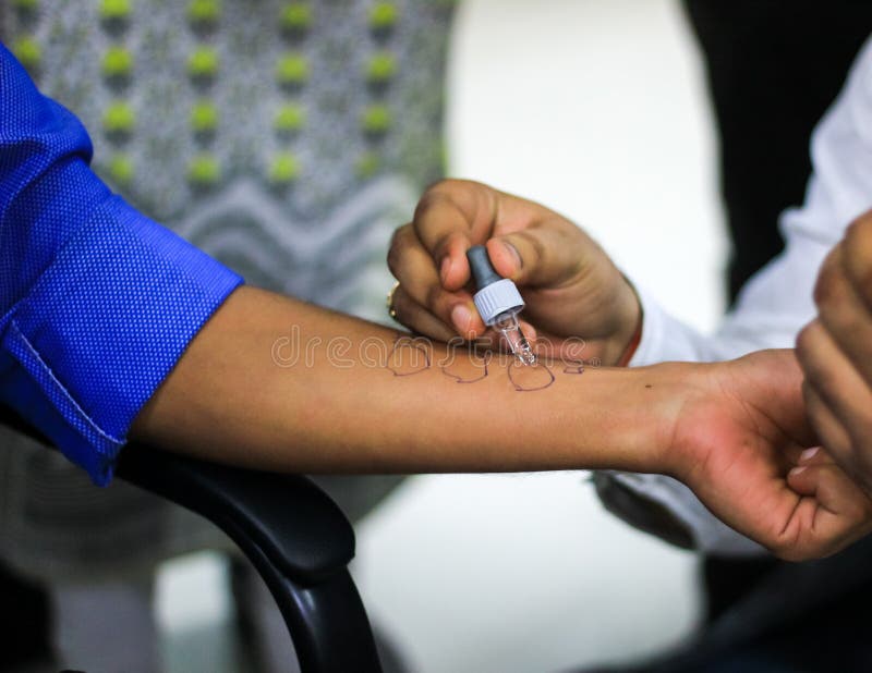Skin Allergy Test Preparation by Doctor on a Patient Hand Using Allergy ...
