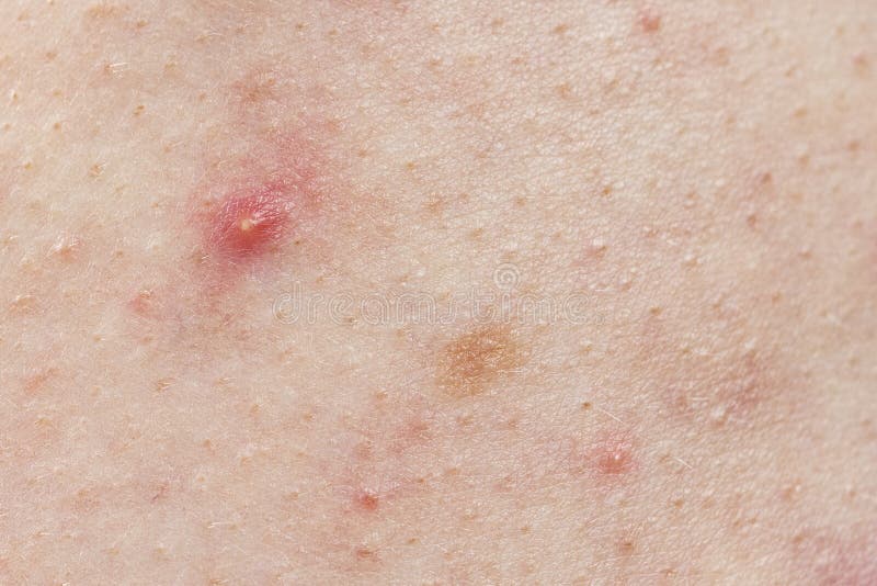 Painful Pimples on the Body Close-up, Treated with a Solution of ...