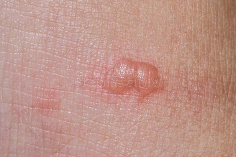 Skin with Blisters.Burn Wound Skin Stock Image - Image of treatment ...