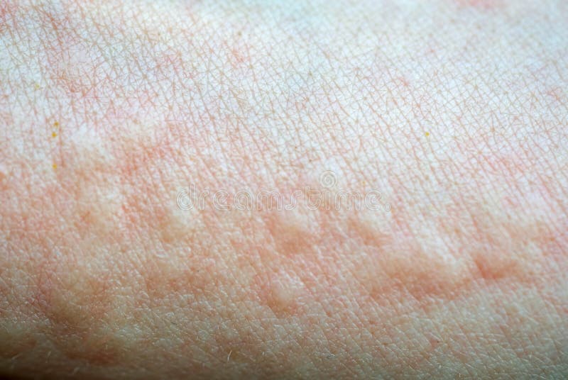 Skin stock photo. Image of pain, blister, dermatology - 94159608