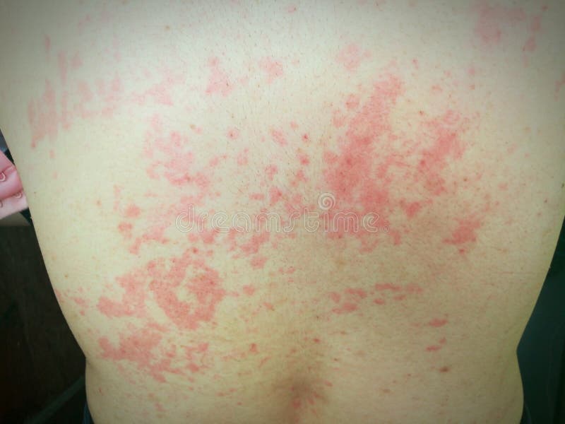 Skin Burn Sickness Hospital Time Stock Photo - Image of emergency ...