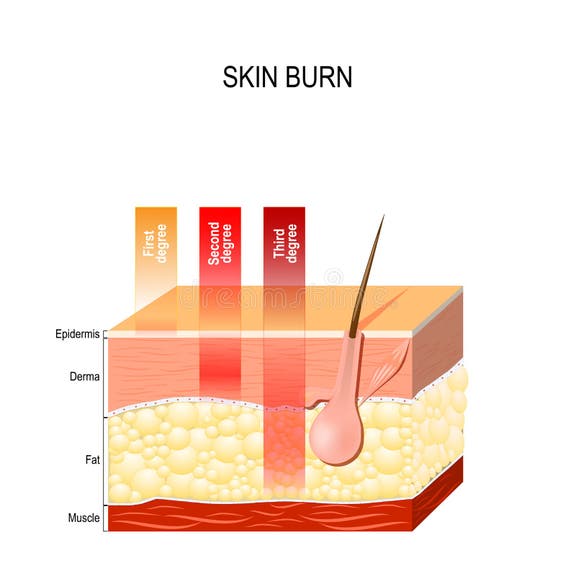 Skin Burn. Three Degrees of Burns. Stock Vector - Illustration of ...