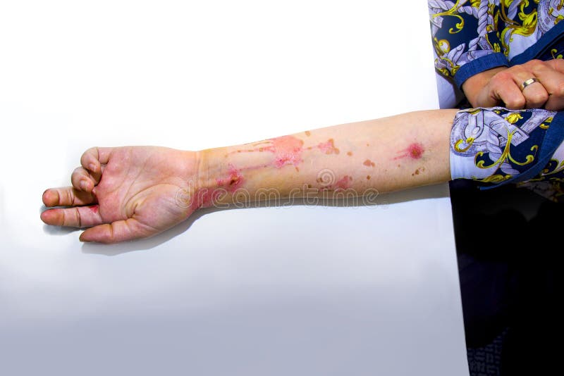 Skin burns on human arm stock image. Image of hurt, treatment - 85499013
