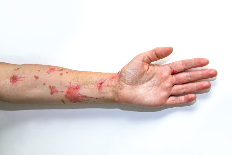 Skin burns on human arm stock image. Image of burn, trauma - 85499013