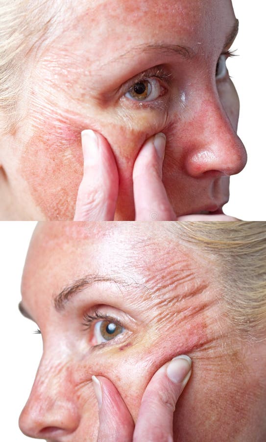 Peeling stock image. Image of health, loss, adult, hand - 8083007