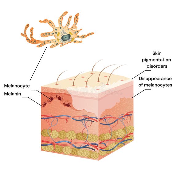 Skin Cut Medicine Problem Skin Vitiligo. Stock Vector - Illustration of ...