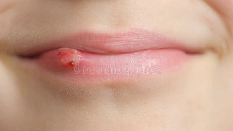 Skin Damage, Wound, Abrasion on the Lip of a Small Child. Stock Video ...