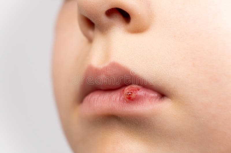 Skin Damage, Wound, Abrasion on the Lip of a Small Child. Stock Image ...