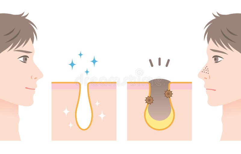 Clean Pores and Clogged Pores on Young Men`s Face Stock Vector ... Clean Pores and Clogged Pores on Young Men`s Face Stock Vector ...