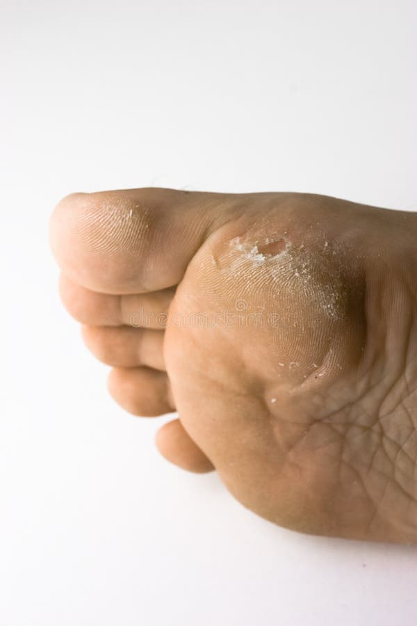 Skin Disease Winter. Healthcare Dry Cracking Skin and Rash Red of Leg ...