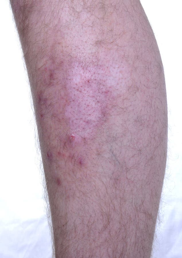 Skin Disease stock image. Image of skin, loss, healthcare - 29559569