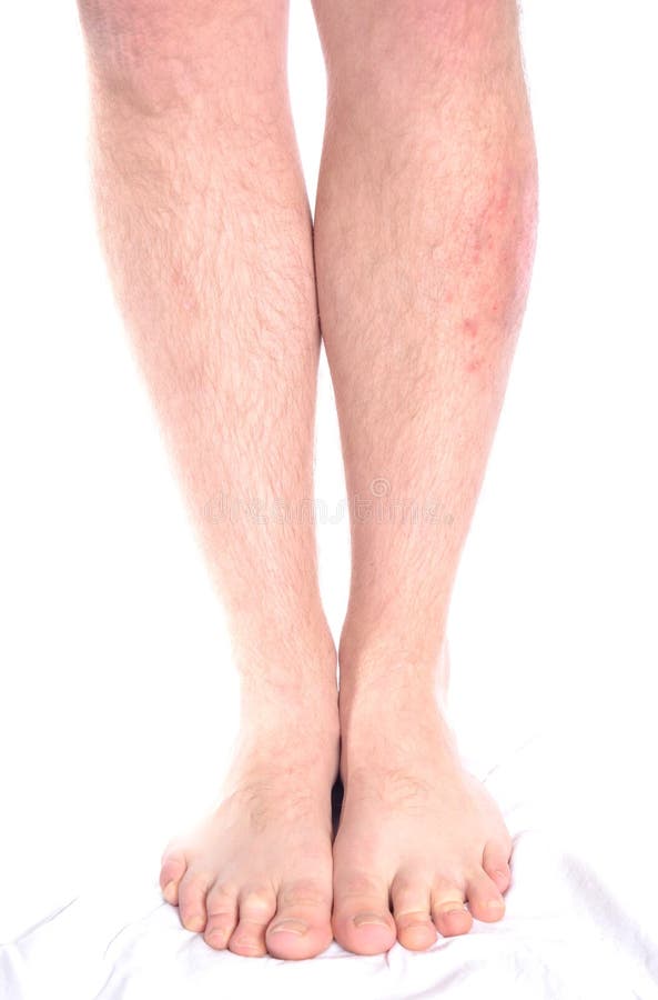 Skin Disease stock image. Image of skin, loss, healthcare - 29559569