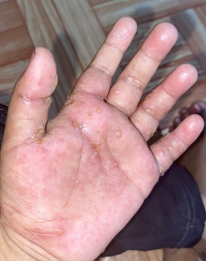 Skin disease in children stock image. Image of young - 250615625