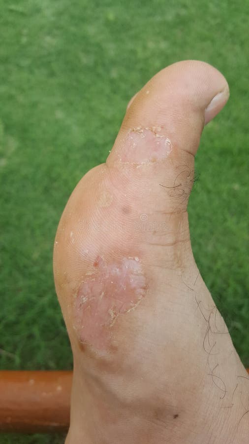 Skin Disease Prickly Heat Rash or Miliaria on Back Skin of Asian Woman ...