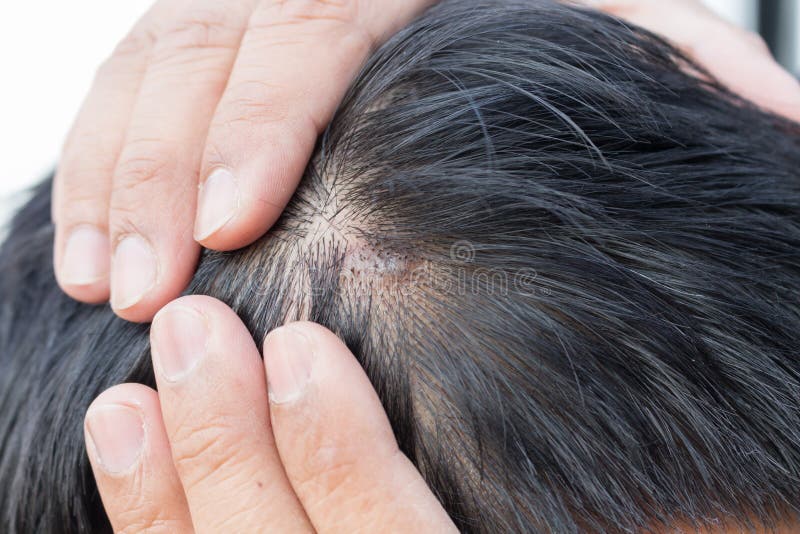 Skin disease on the head stock image. Image of shallots - 66892259