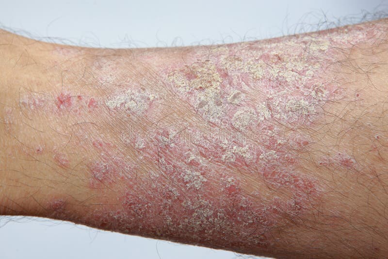 Textile Dermatitis Stock Photos - Free & Royalty-Free Stock Photos from ...