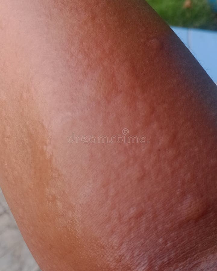 Skin Diseases, Cold Temperature Allergies Stock Photo - Image of skin ...