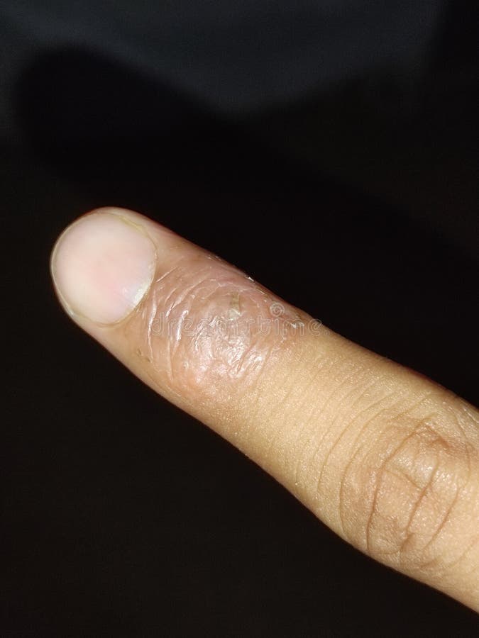 Skin Diseases and the Problem Around the Hand and Finger Stock Photo ...