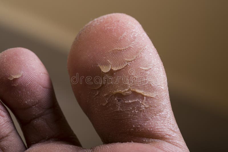 4,997 Callus Stock Photos - Free & Royalty-Free Stock Photos from ...