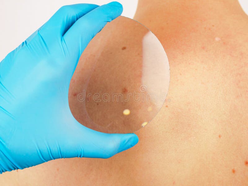 Skin Examination by a Dermatologist: Examination of Moles and ...