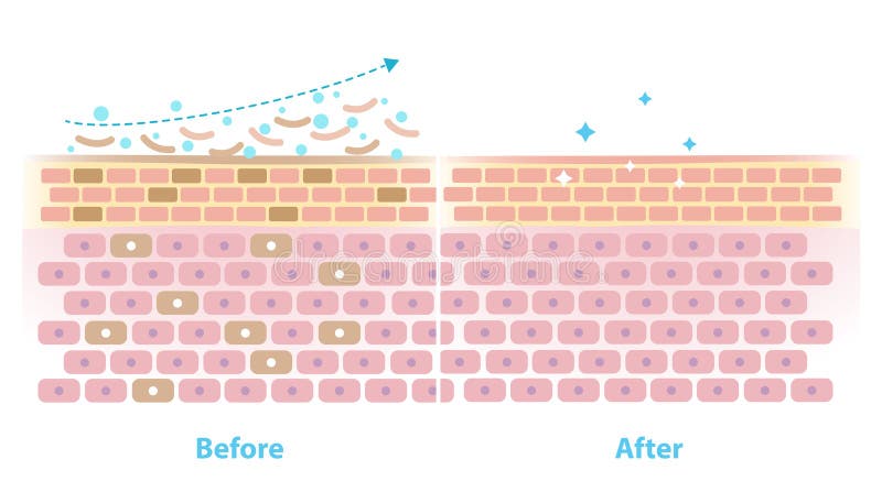 Before and after Skin Exfoliation Vector Illustration on White ...