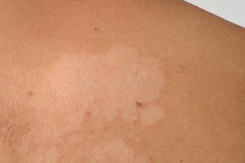 Skin fungus back stock image. Image of closeup, body - 79487837